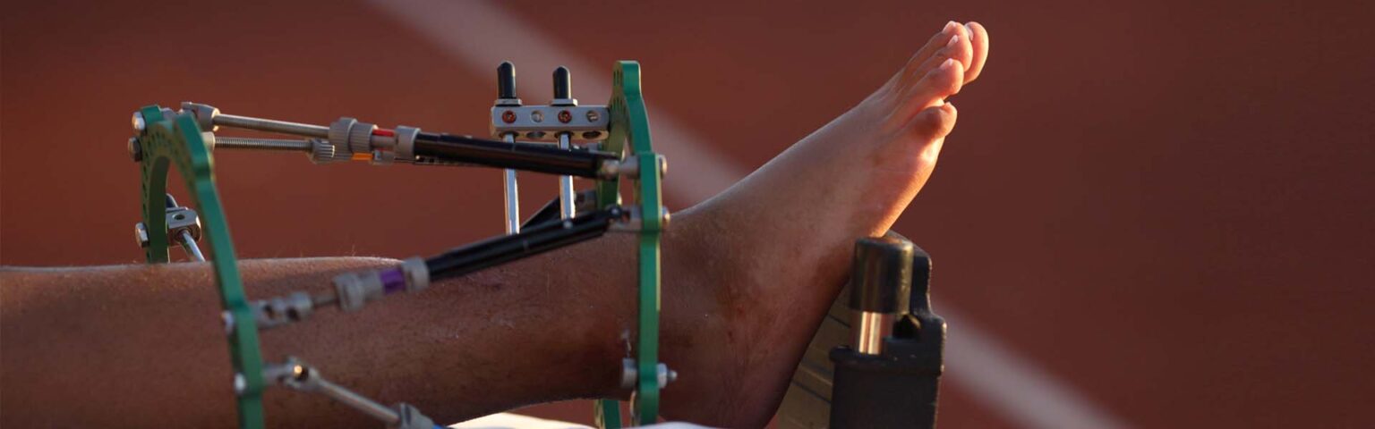 External Fixation: Expert Foot & Ankle Care in Sarasota