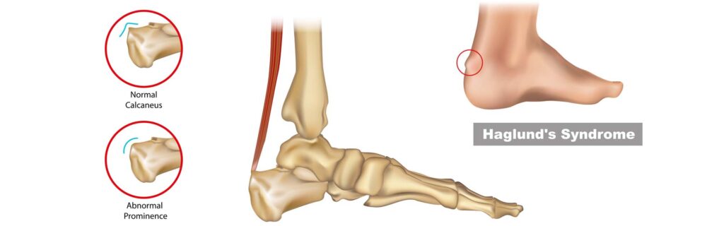 Bradenton Haglund's Deformity Treatment: Expert Care