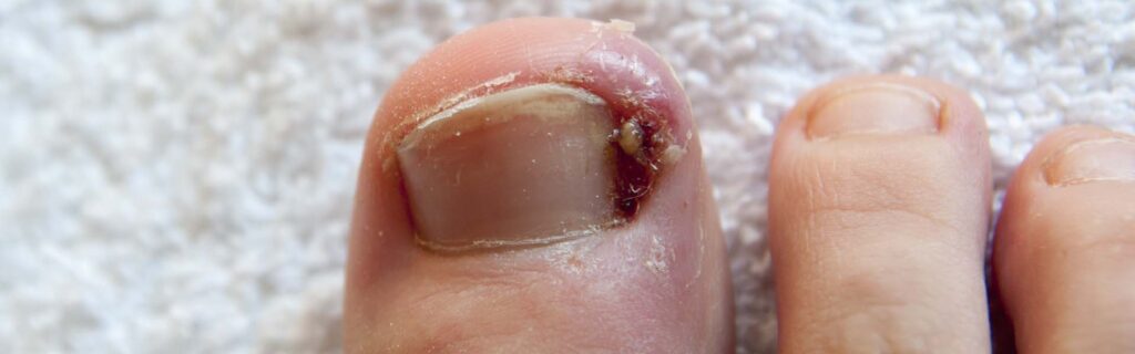 Ingrown Nail Relief: Florida Foot & Ankle Specialists