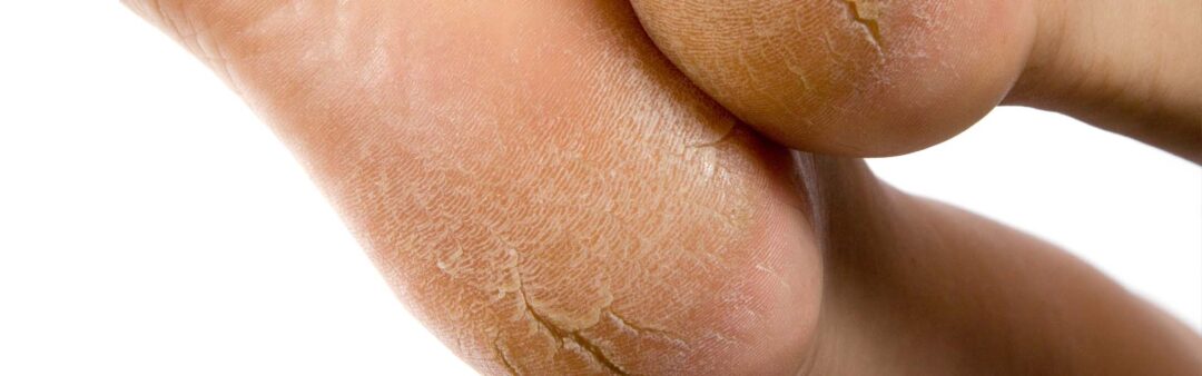 Cracked Heels Treatment | Florida Foot & Ankle Specialists